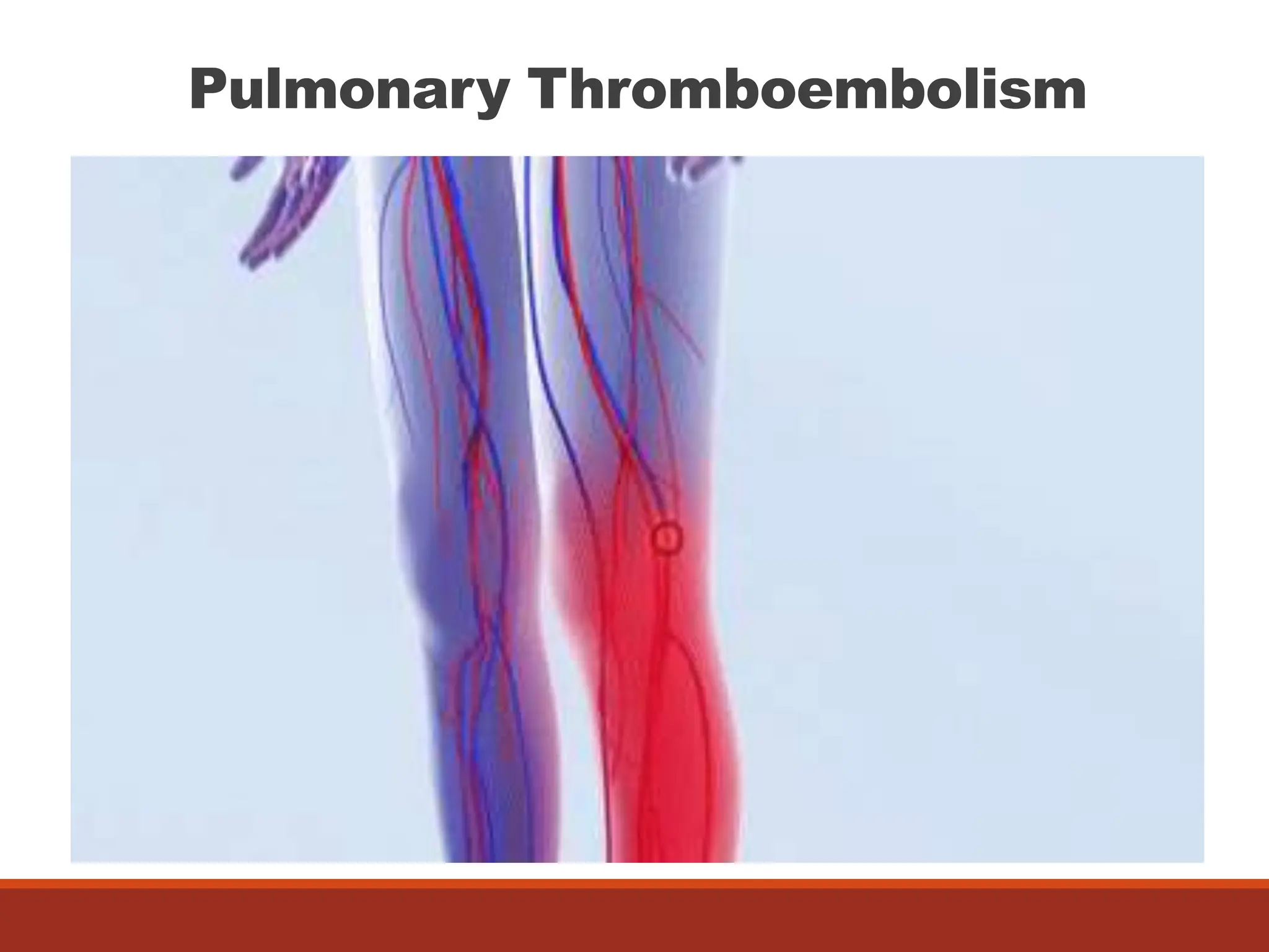 Pulmonary Thromboembolism - etilogy, types, medical- Surgical and ...