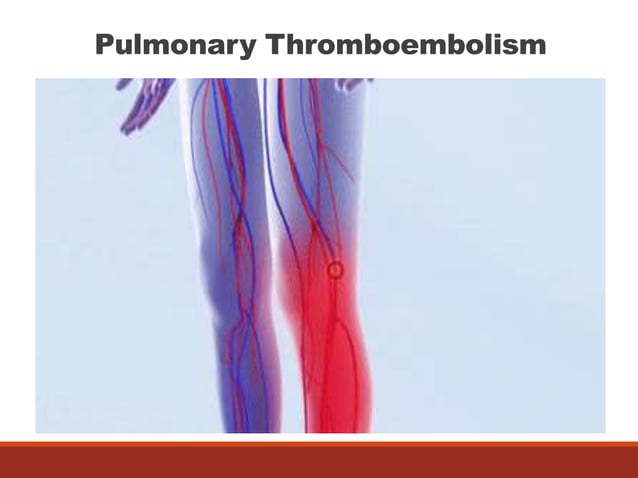 Pulmonary Thromboembolism - etilogy, types, medical- Surgical and ...