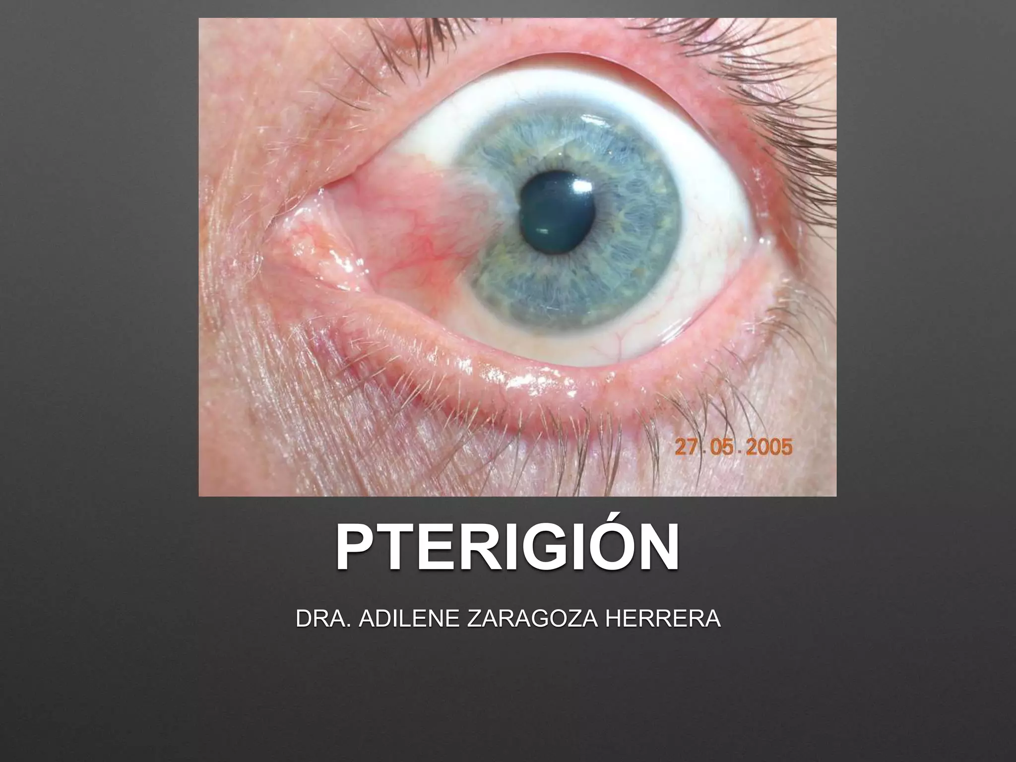 Pterigion | PPTX