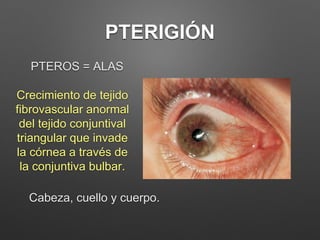Pterigion | PPTX