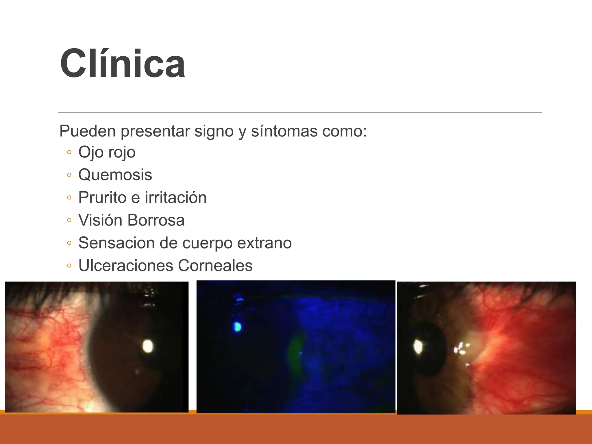 Que es Pterigion, clasificacion, clínica | PPTX