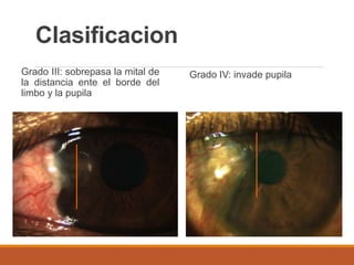 Que es Pterigion, clasificacion, clínica | PPTX
