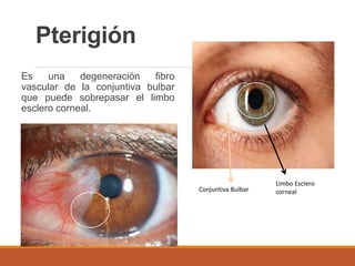 Que es Pterigion, clasificacion, clínica | PPTX