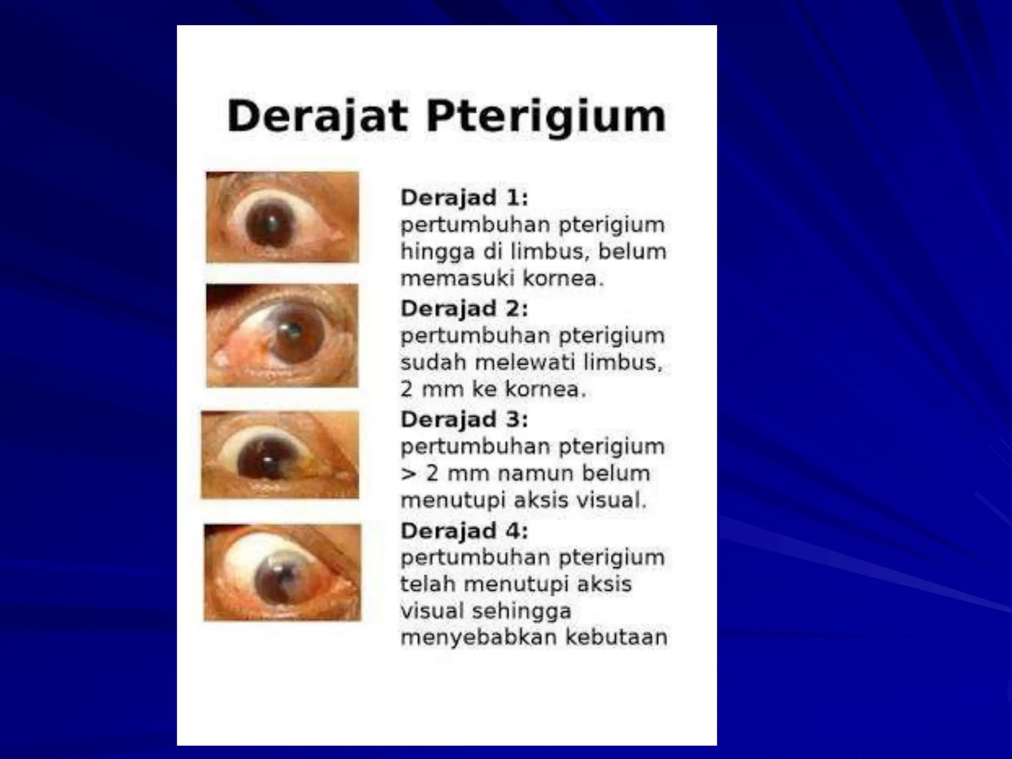 PTERIGIUM kelainan pada konjungtiva bulbi, berbentuk segitiga ,berada ...