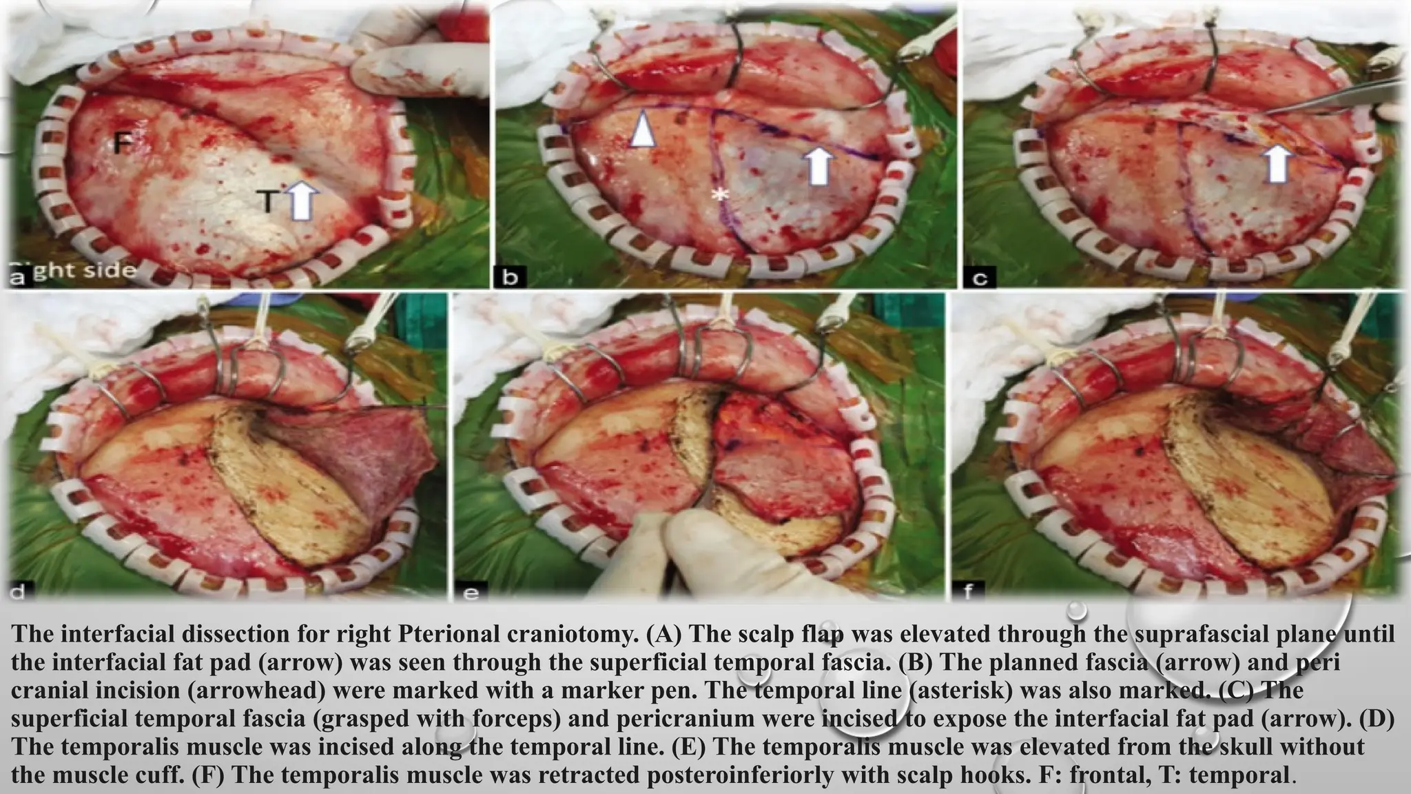 Pterional Craniotomy By Dr.Ahmad aly alkholy.pptx