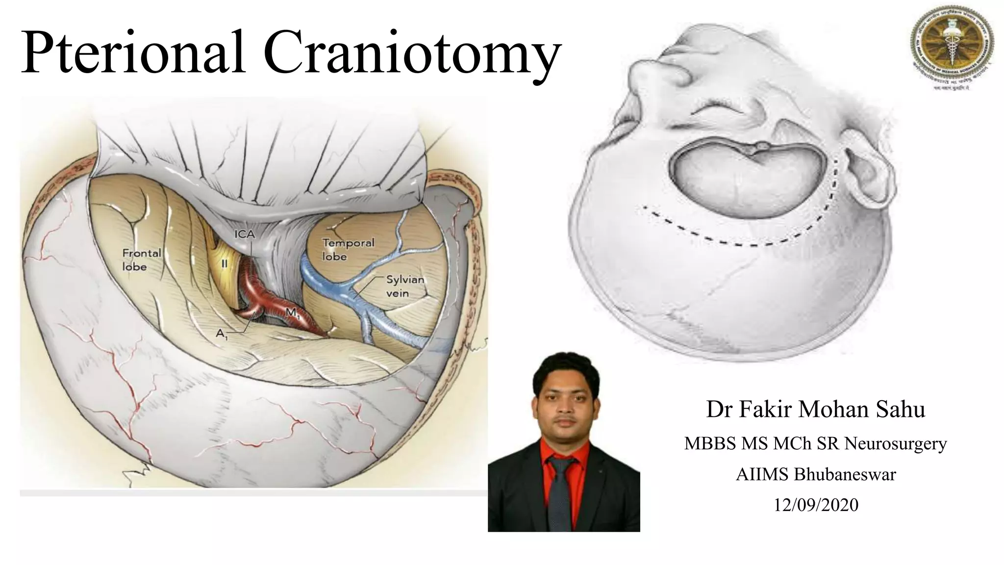 Pterional craniotomy | PPTX