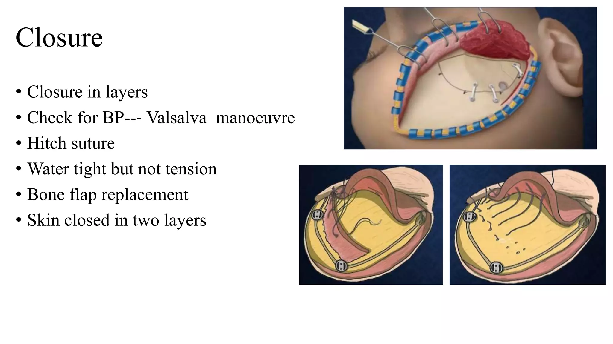 Pterional craniotomy | PPTX