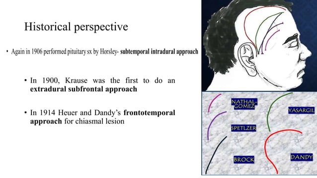 Pterional craniotomy | PPTX | Death, Injury, or Military Conflict ...