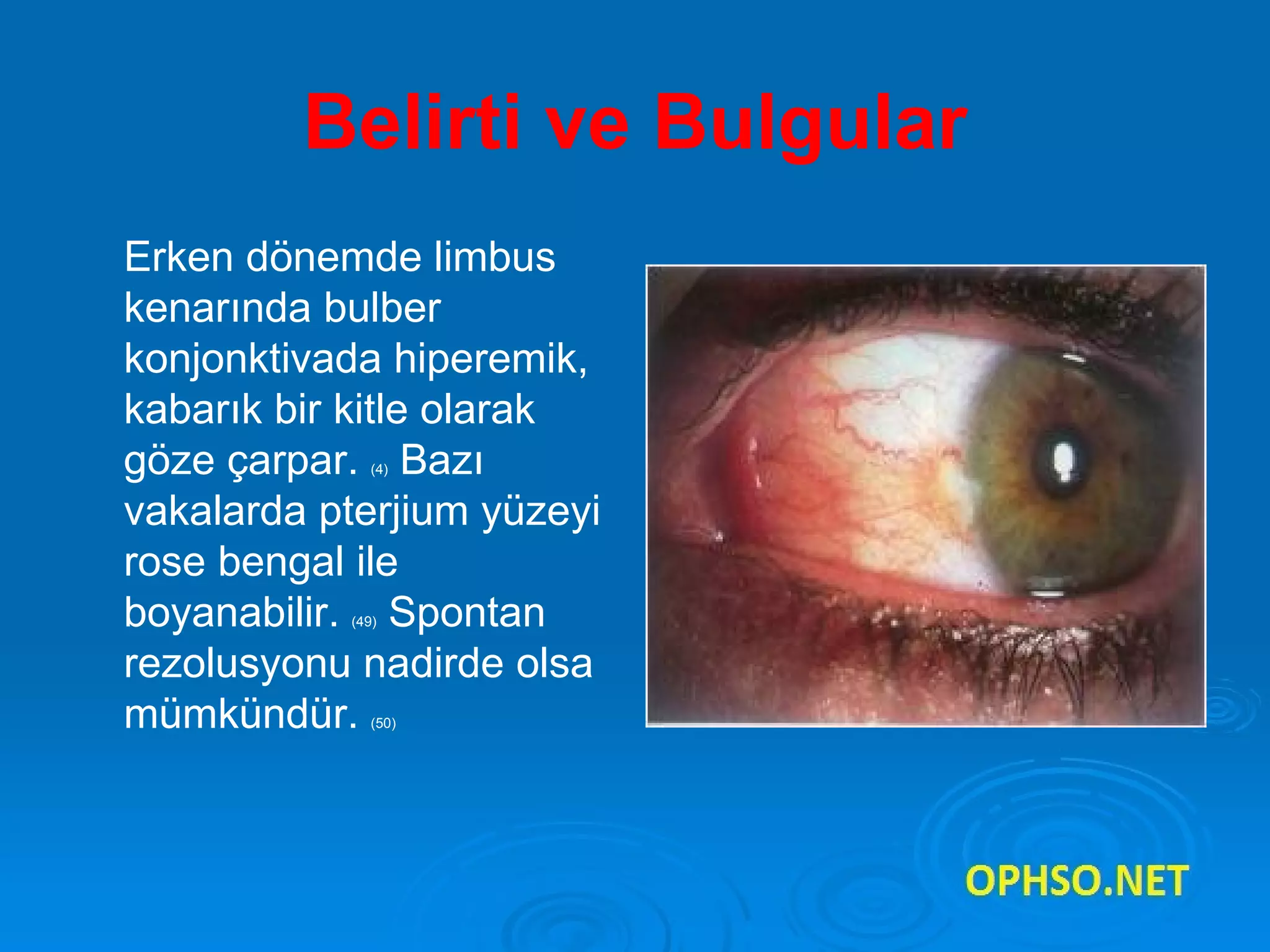 Pterjium anatomi-klinik | PPT