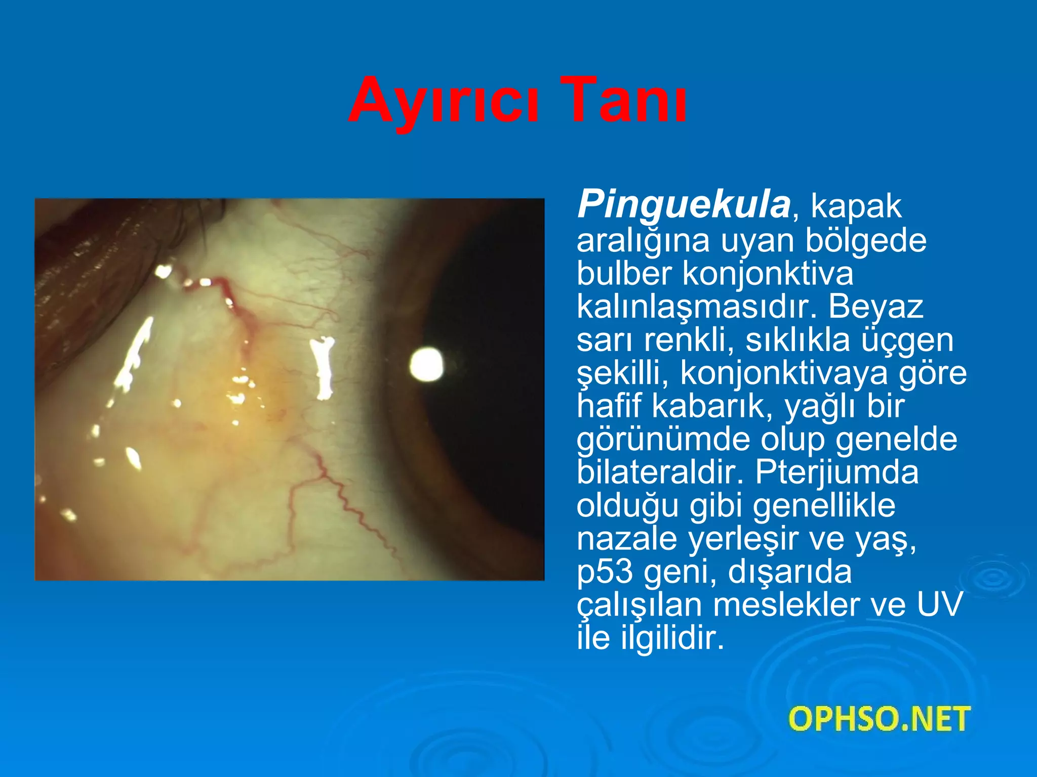 Pterjium anatomi-klinik | PPT