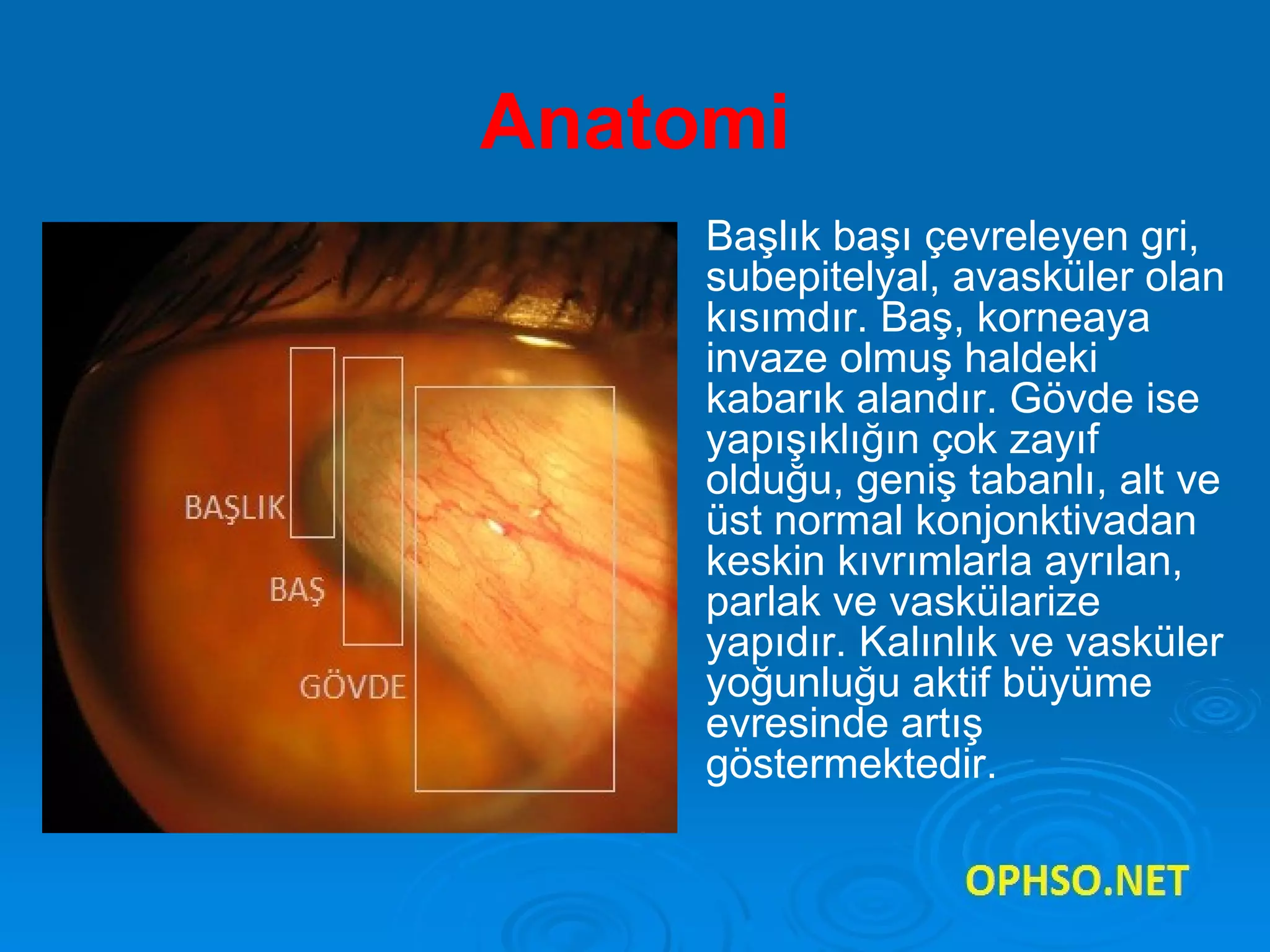 Pterjium anatomi-klinik | PPT