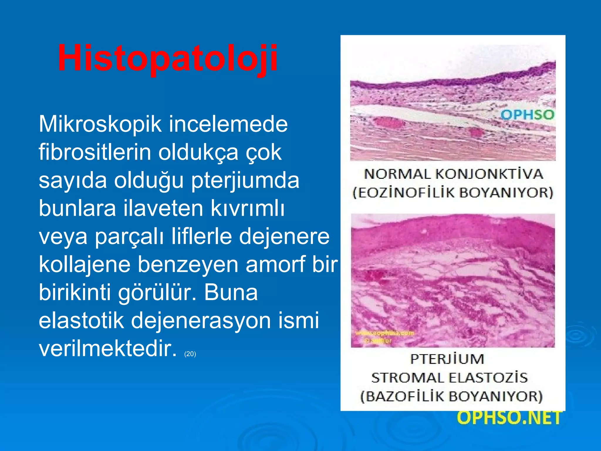 Pterjium anatomi-klinik | PPT