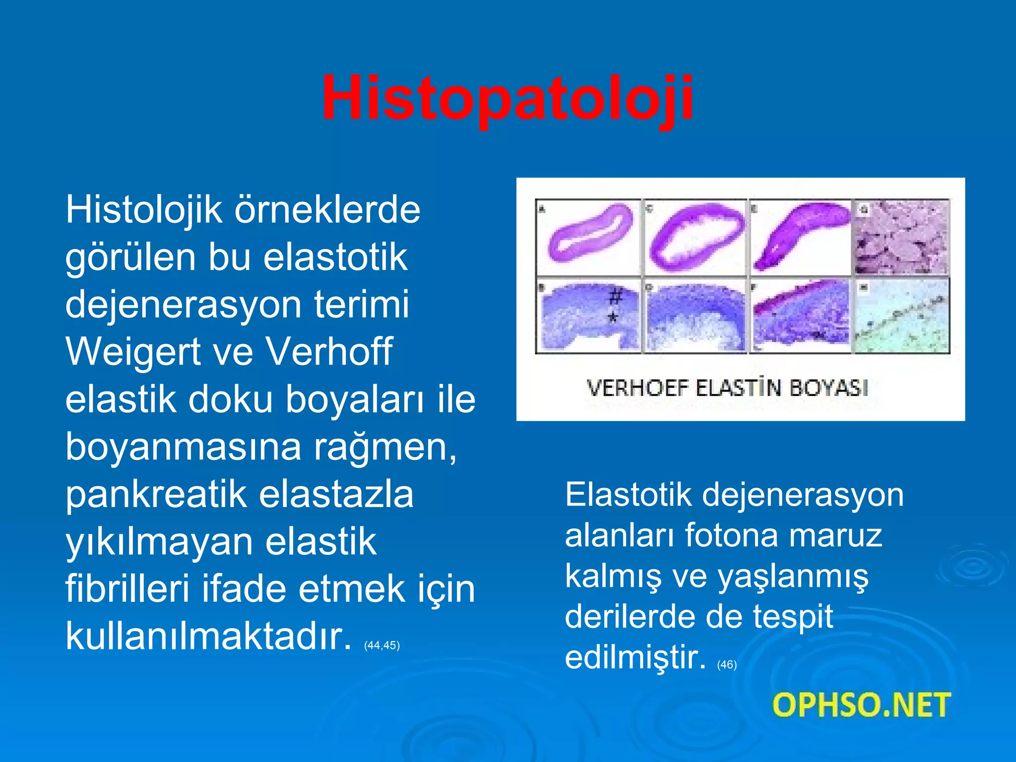 Pterjium anatomi-klinik | PPT