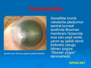 Pterjium anatomi-klinik | PPT