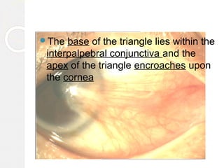 Pterygium | PPT