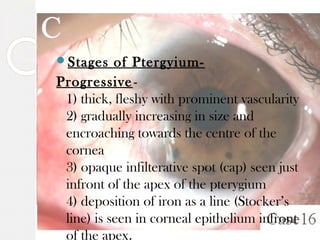 Pterygium | PPT