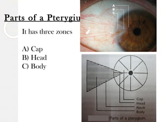 Pterygium | PPT