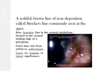 Pterygium | PPT