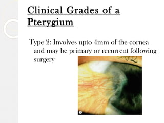 Pterygium | PPT
