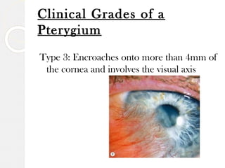 Pterygium | PPT