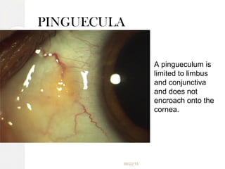 Pterygium | PPT