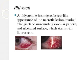 Pterygium | PPT