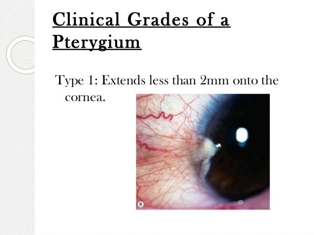 Pterygium