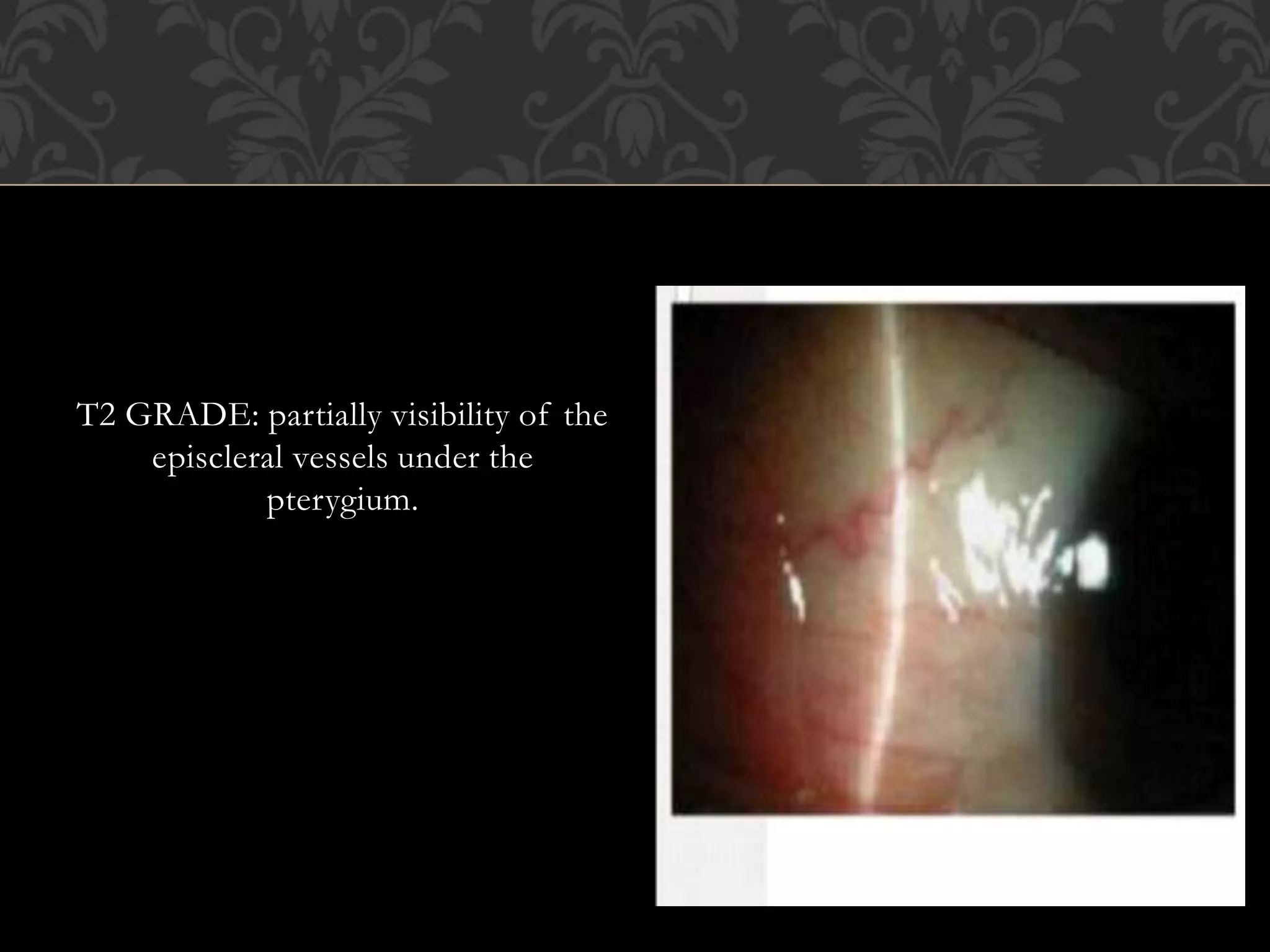Pterygium & ITS MANAGEMENT | PPTX