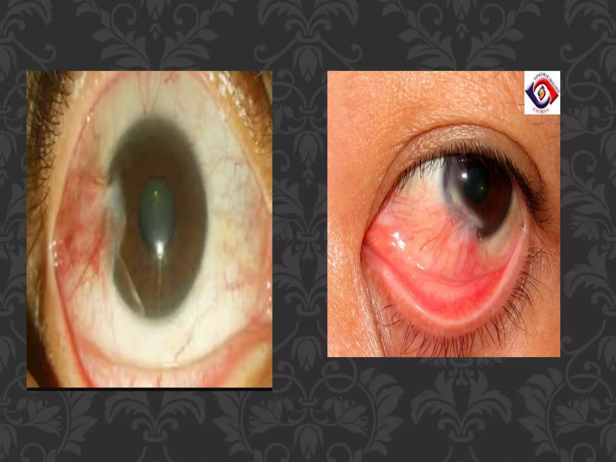 Pterygium & ITS MANAGEMENT | PPTX
