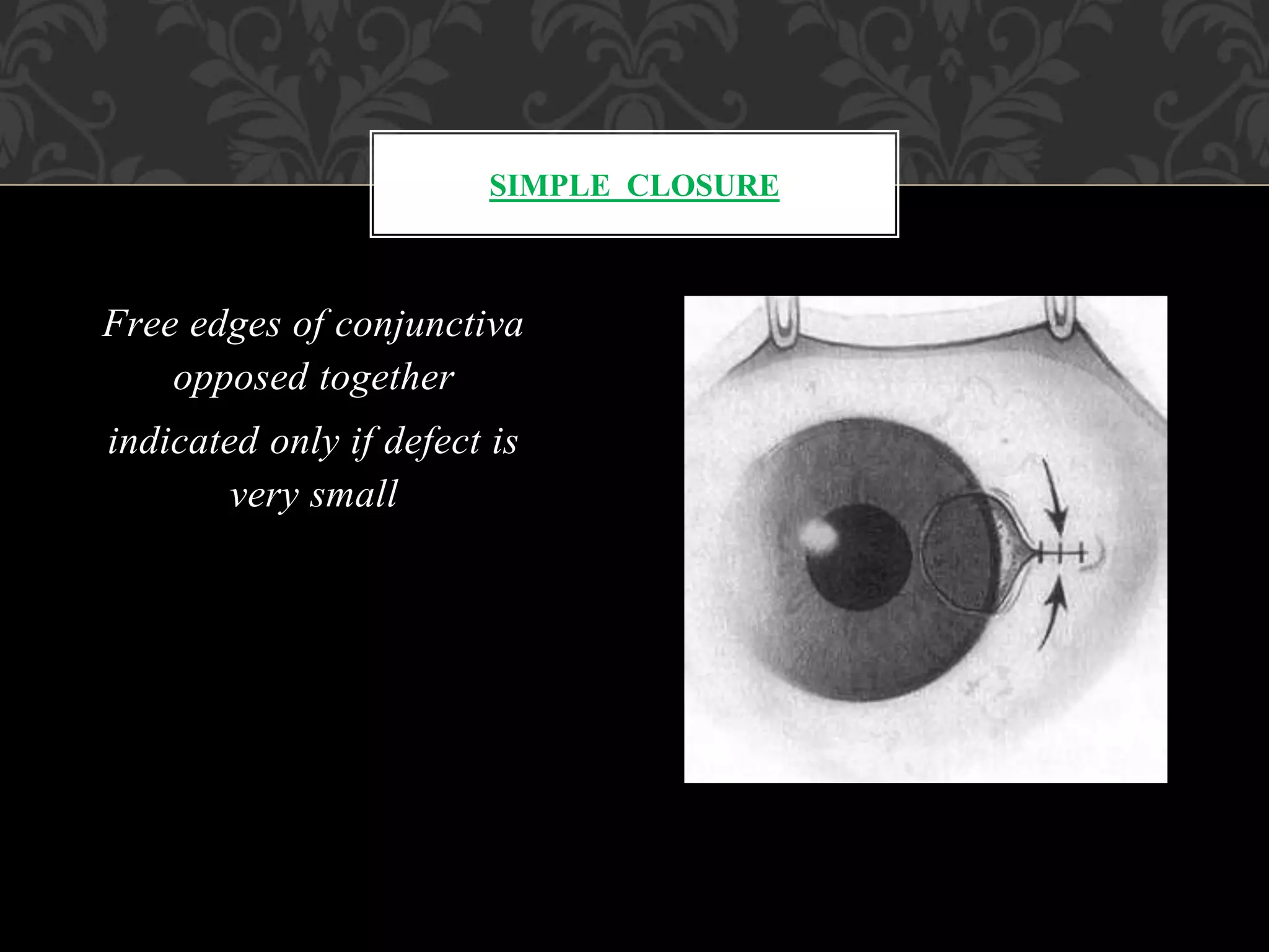 Pterygium & ITS MANAGEMENT | PPTX