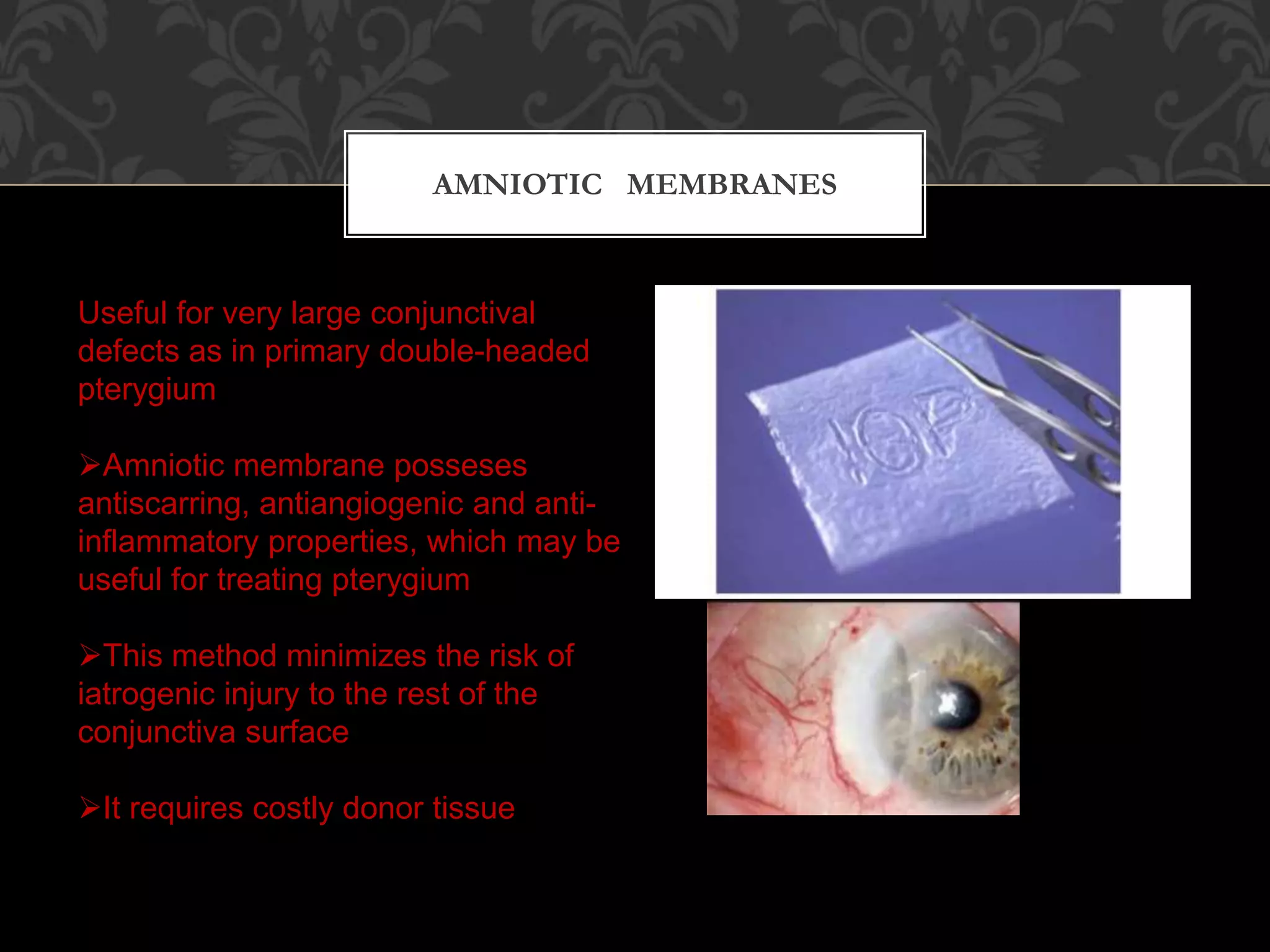 Pterygium & ITS MANAGEMENT | PPTX