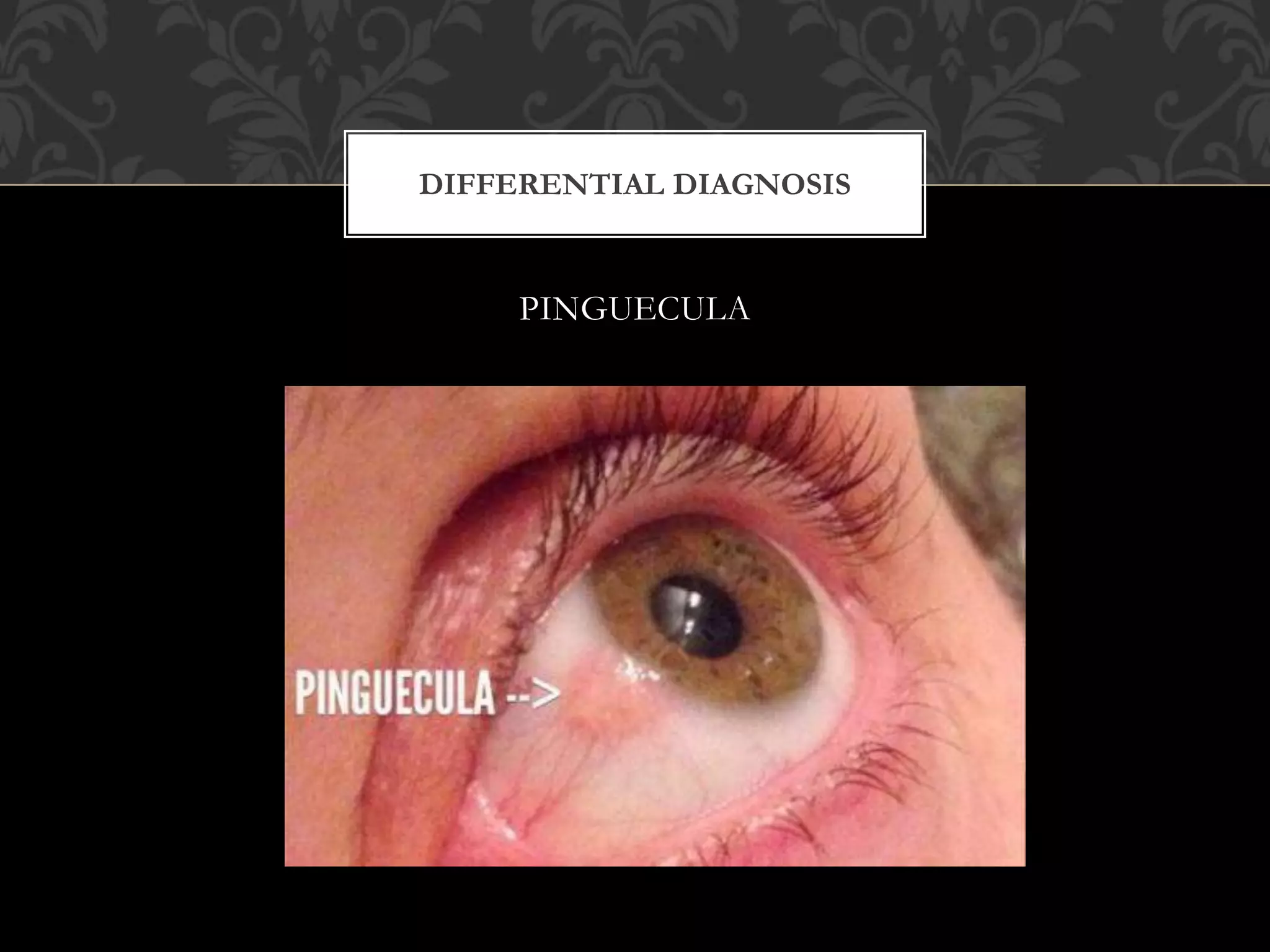 Pterygium & ITS MANAGEMENT | PPTX