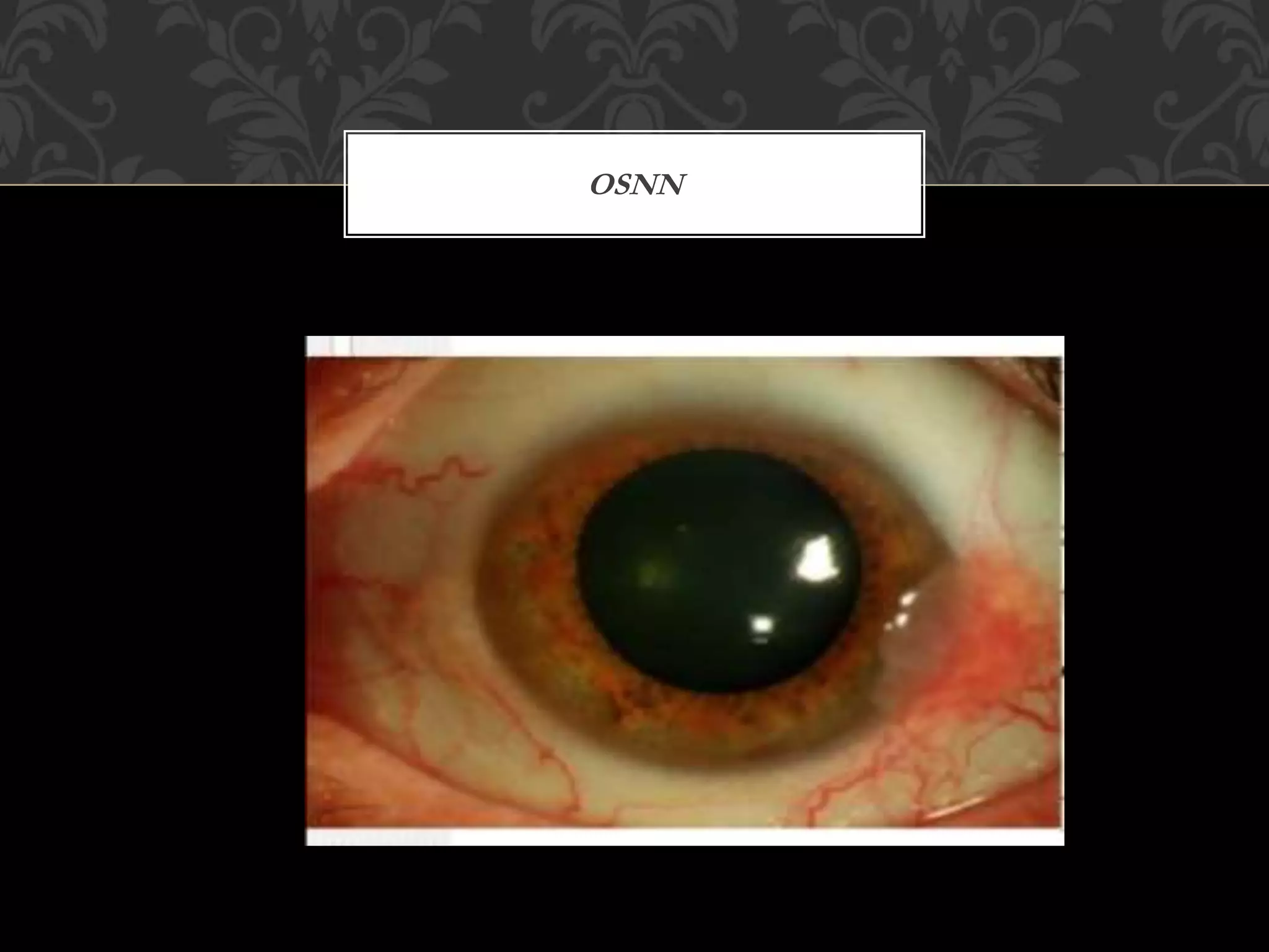 Pterygium & ITS MANAGEMENT | PPTX