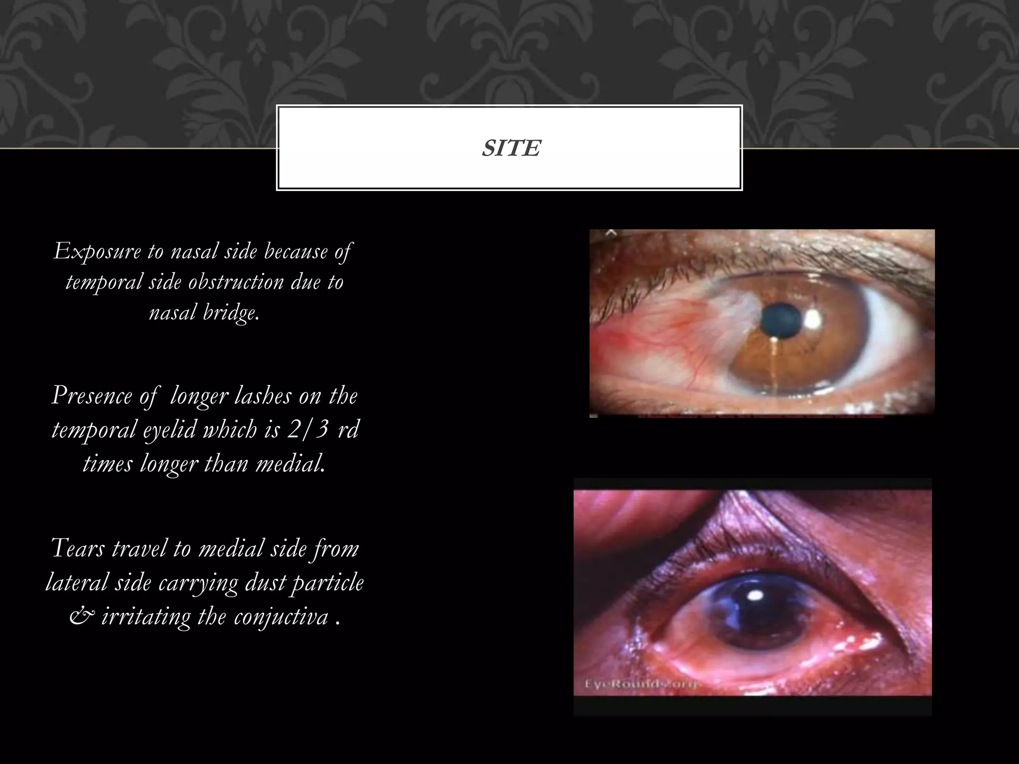 Pterygium & ITS MANAGEMENT | PPTX