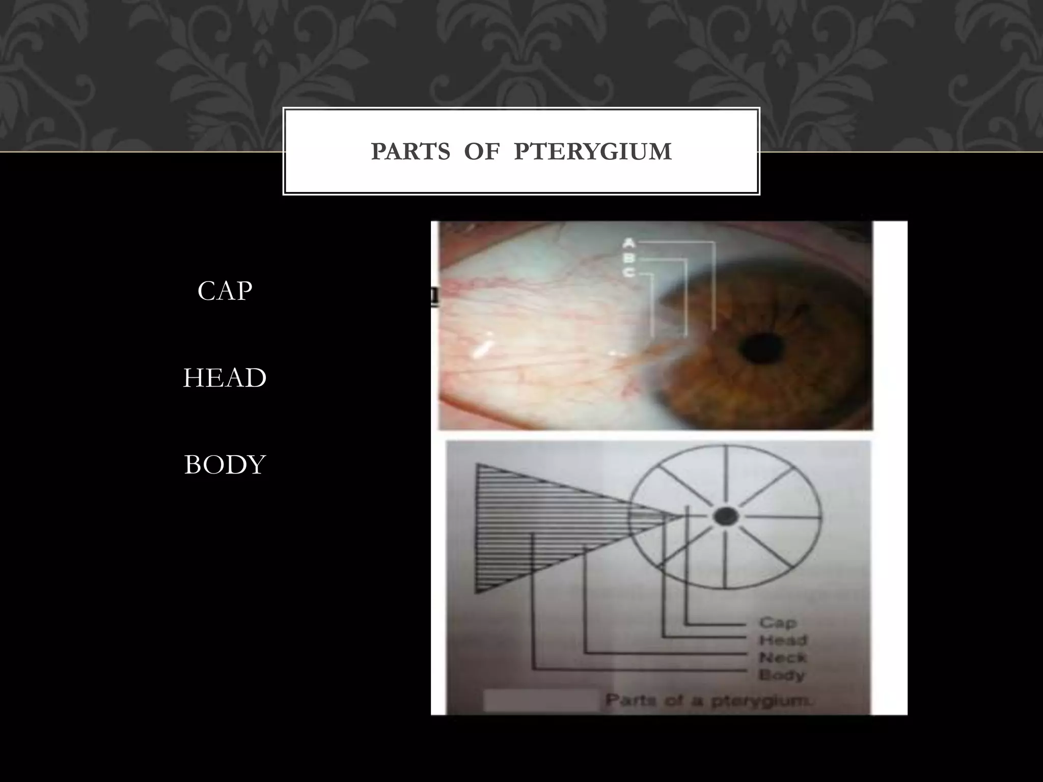 Pterygium & ITS MANAGEMENT | PPTX