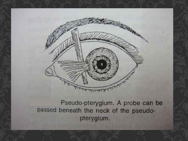 Pterygium & ITS MANAGEMENT | PPTX
