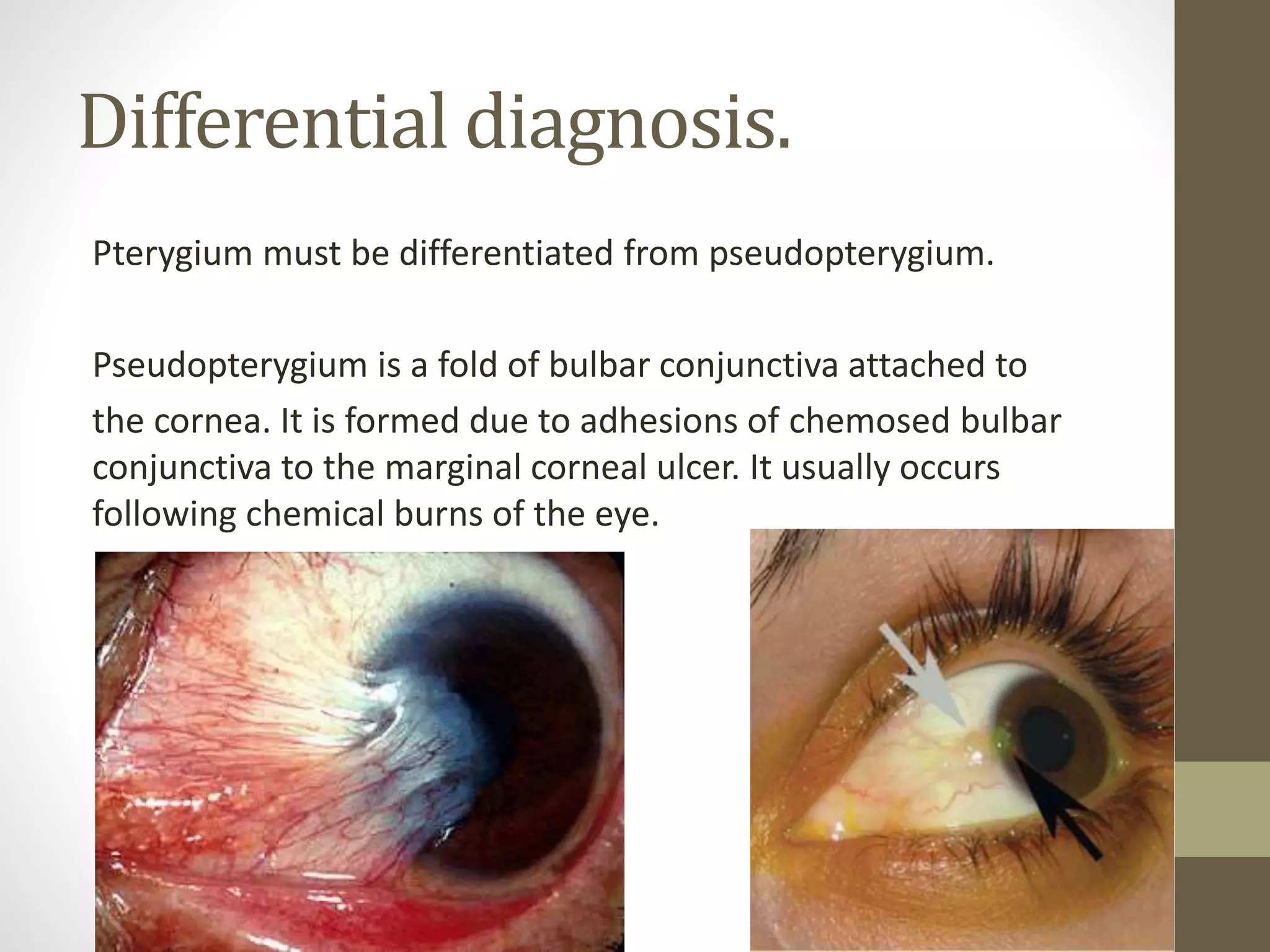 Pterygium | PPTX