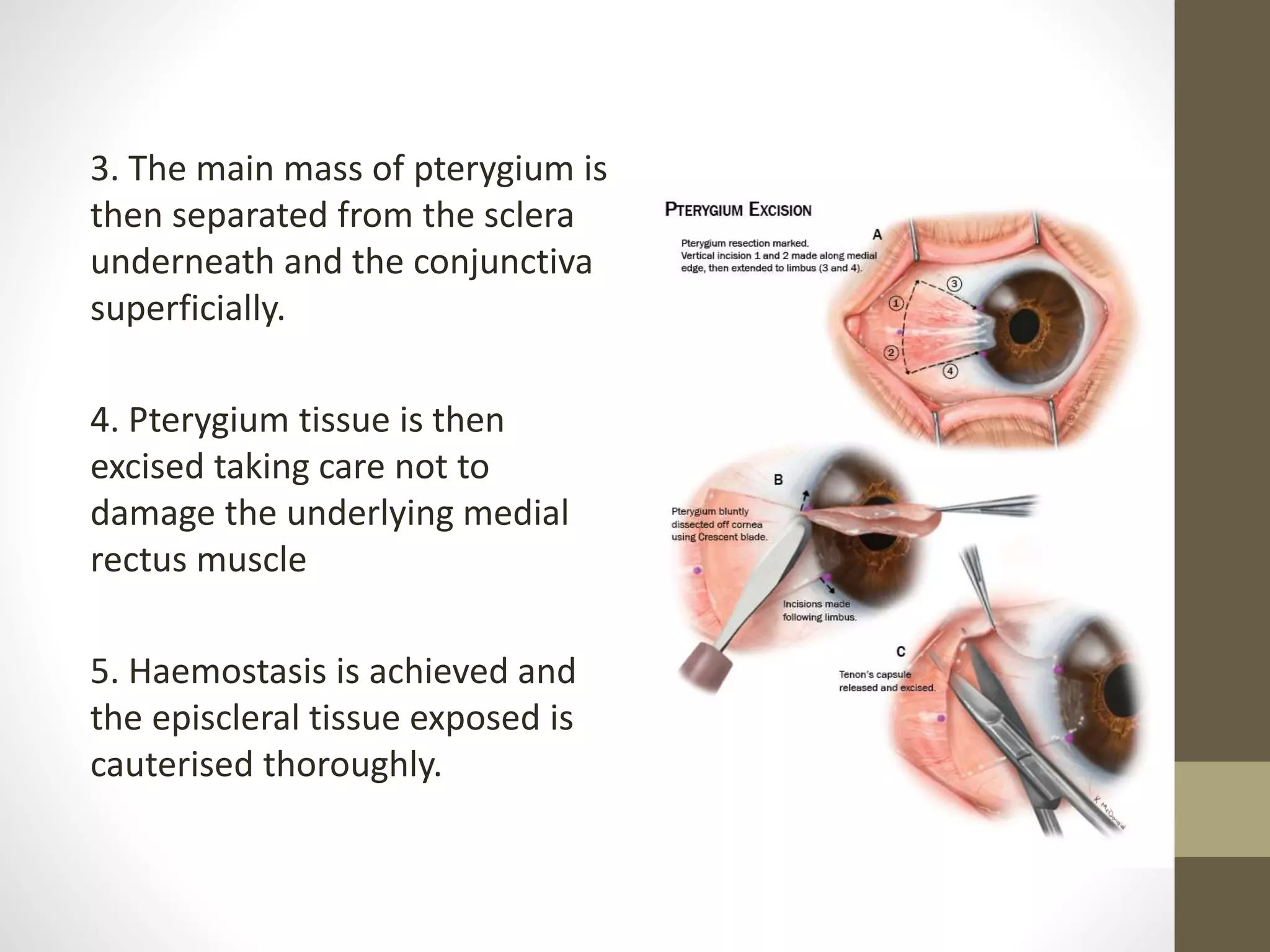 Pterygium | PPTX