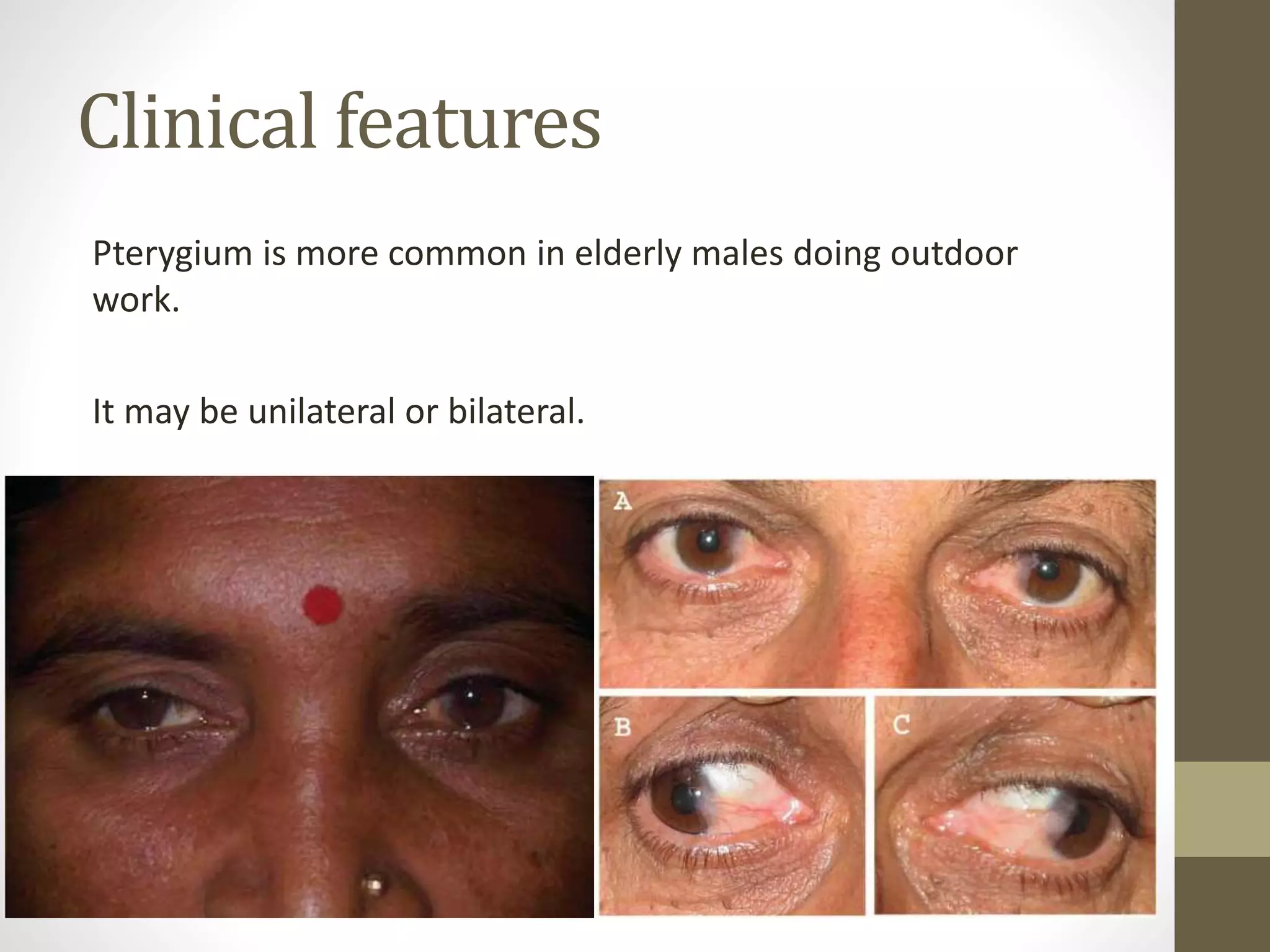 Pterygium | PPTX
