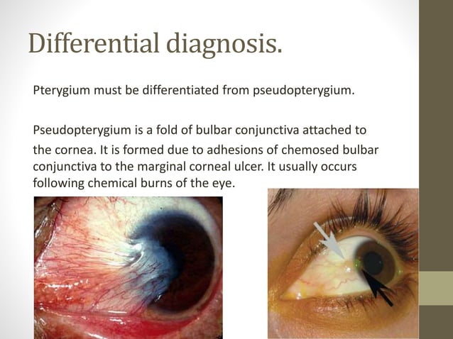 Pterygium | PPTX