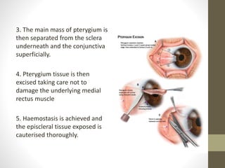 Pterygium | PPTX