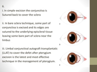 Pterygium | PPTX