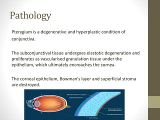 Pterygium | PPTX