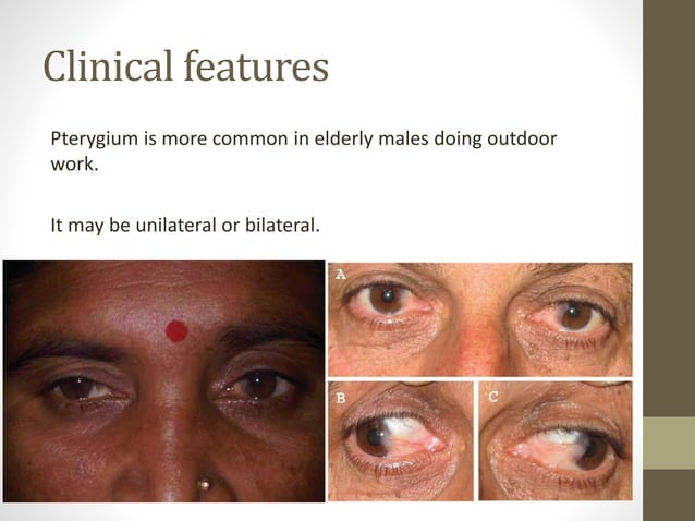 Pterygium | PPTX