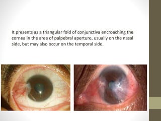 Pterygium | PPTX