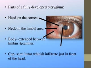 Pterygium | PPTX
