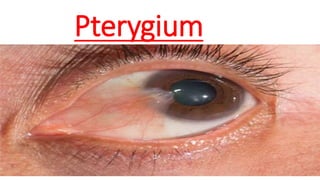 pterygium आर्म.pdf.pptx