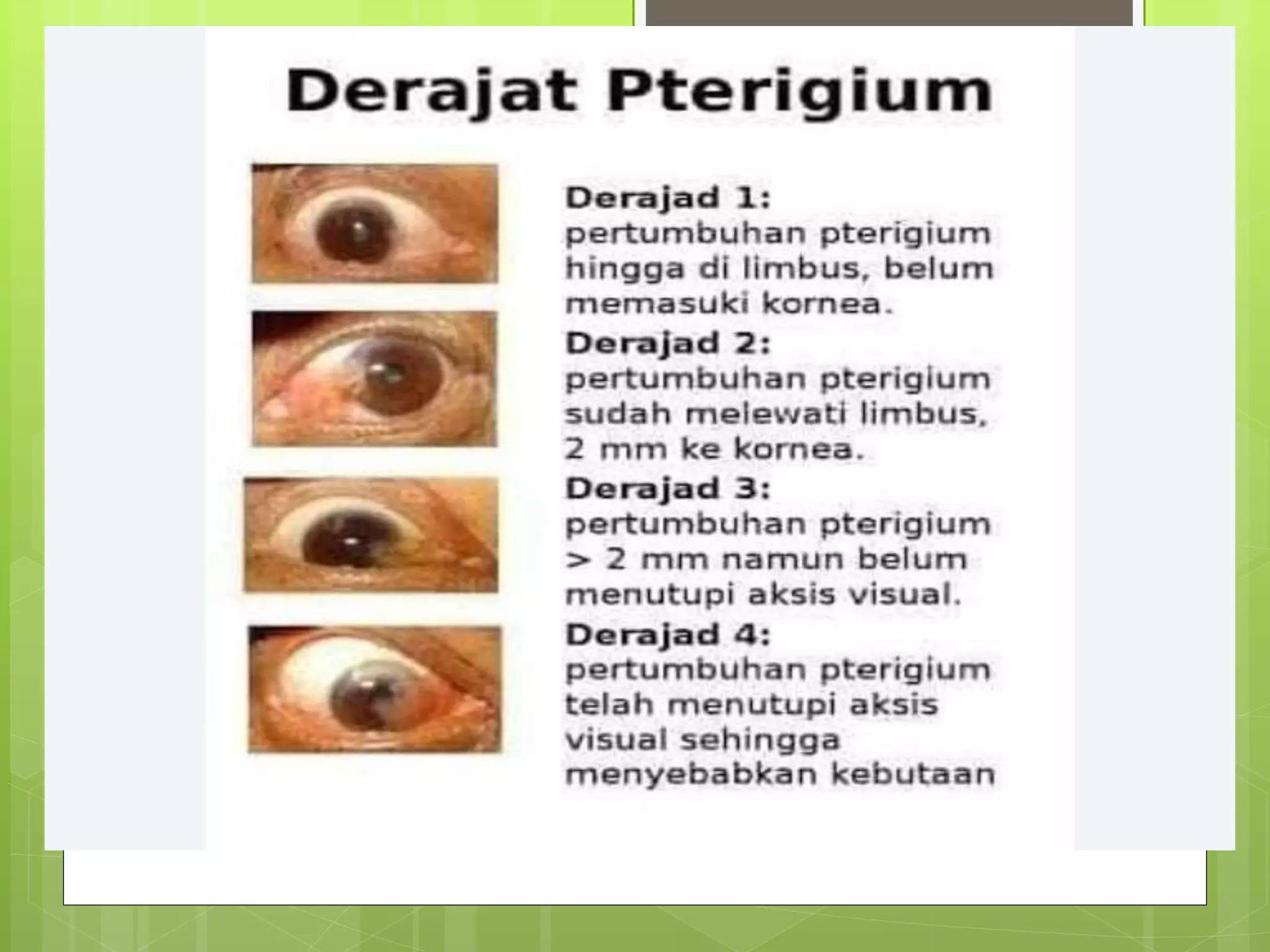 pterygium.pptx