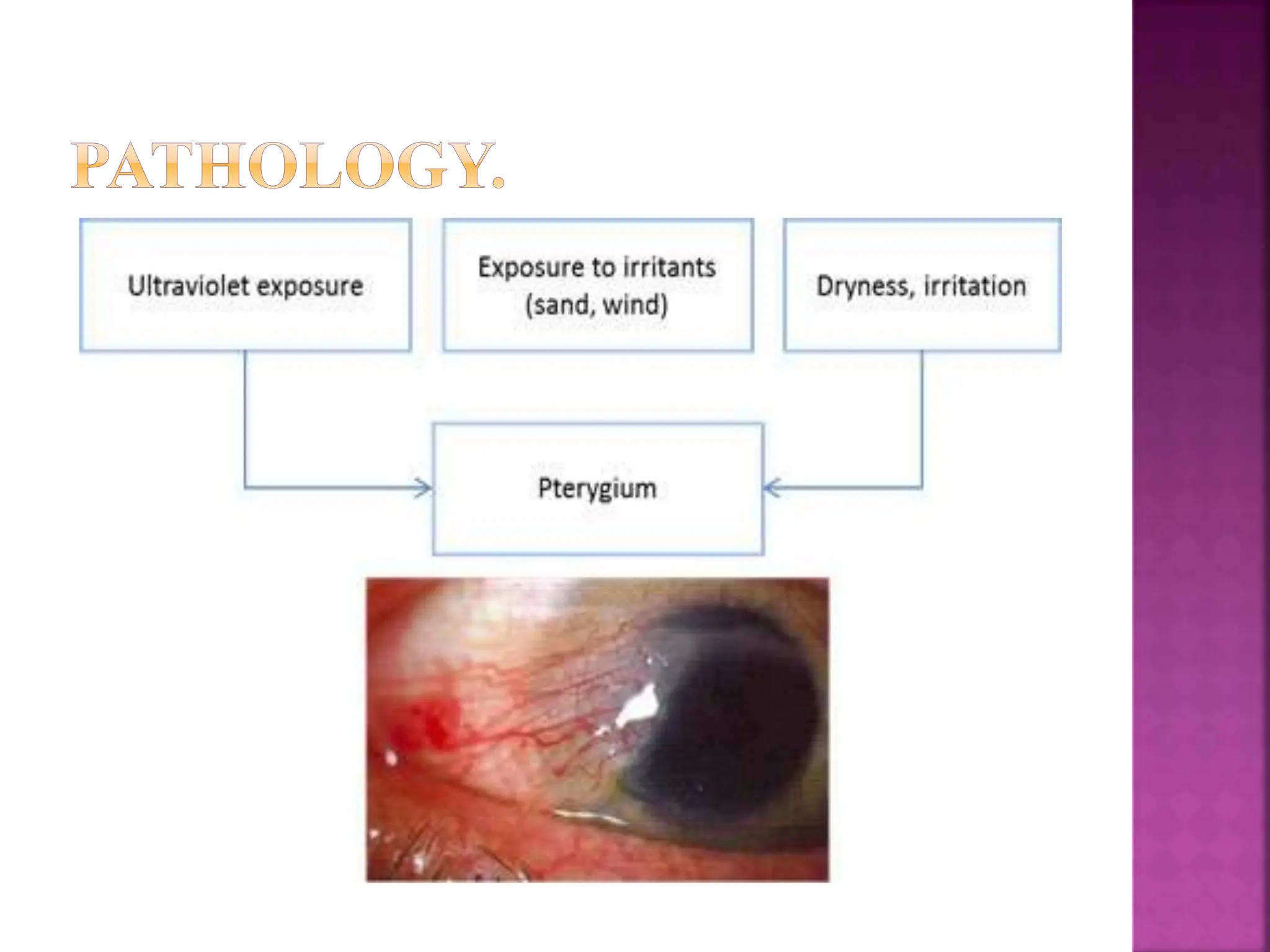 PTERYGIUM ,clinical picture and its management.pptx