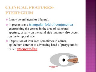 PTERYGIUM ,clinical picture and its management.pptx